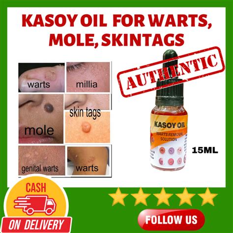 15ml Kasoy Oil Wart And Mole Remover Solution Wart Remover Solution