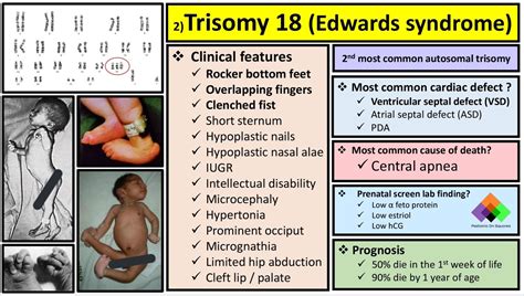 Edwards Syndrome Feet