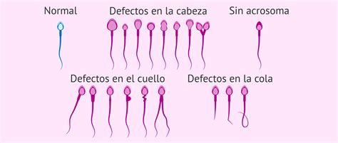 Problemas De Morfologia De Los Espermatozoides