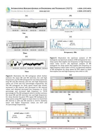 IRJET Sleep Apnea Detection Using Physiological Signals PDF