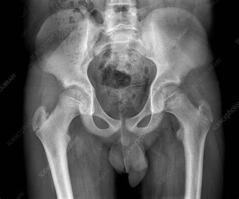 Slipped Capital Femoral Epiphysis X Ray Stock Image C0386678