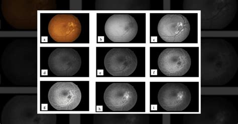 Management Of Peripapillary Choroidal Neovascular Membrane In A 60 Year Old Woman Medsynapse