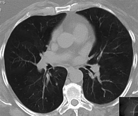 Chest Ct Diffuse Bilateral Geographic Mosaic Attenuation And Bilateral