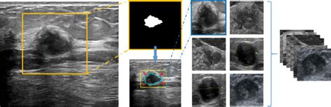 Differentiating Non Lactating Mastitis And Malignant Breast Tumors By