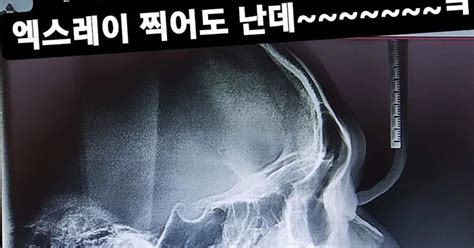 김원효 얼굴 뼈 엑스레이 충격 결과증명사진으로 써도 되겠어