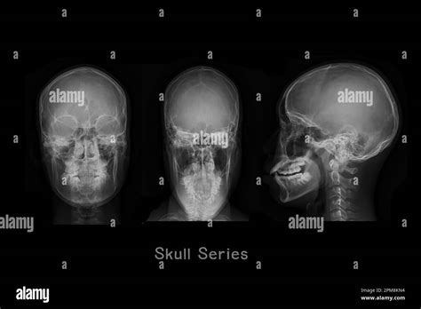 X Ray Image Of Skull Aptowns And Lateral View Or Skull Series For