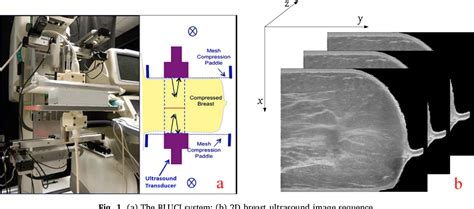 Figure From Medical Breast Ultrasound Image Segmentation By Machine Learning Semantic Scholar