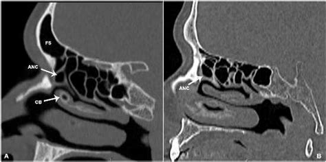 Sagittal Cross Section View Of Two Different Patients Paranasal Sinus