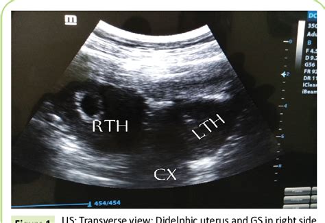 Figure 1 From Uterus Didelphys With Pregnancy And Recurrent Pregnancy