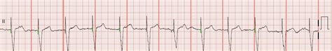 Float Nurse Ekg Rhythm Strips 56 Atrial Fibrillation