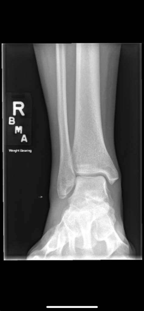 Lateral Malleolus Avulsion Fracture Rradiology