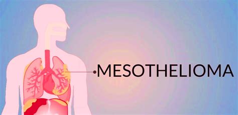 What Are The Most Common Complications Of Mesothelioma Surgery