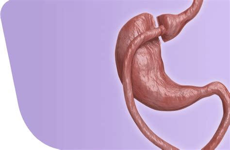Gastric Bypass Surgery