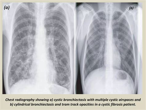 Presentation1 Pptx Radiological Imaging Of Bronchiectasis Pptx