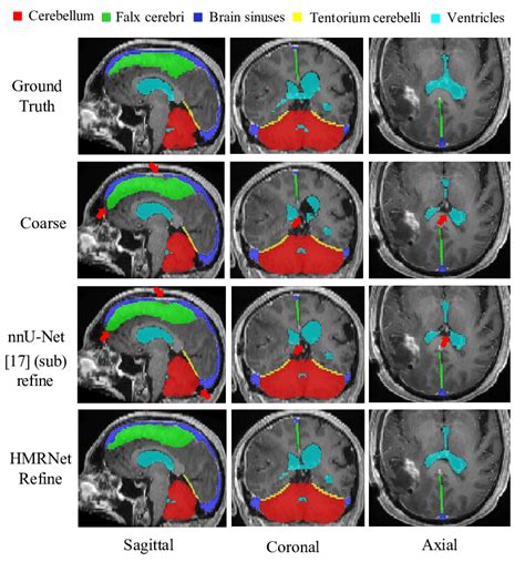 Visual Comparison Of Coarse Segmentation And Refinement Based On Download Scientific Diagram