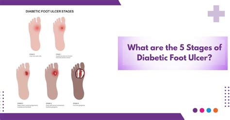 What Are The 5 Stages Of Diabetic Foot Ulcer