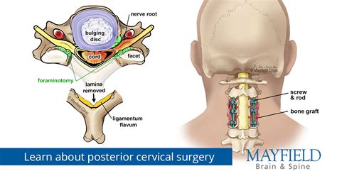 Posterior Cervical Surgery Mayfield Brain And Spine Cincinnati Ohio