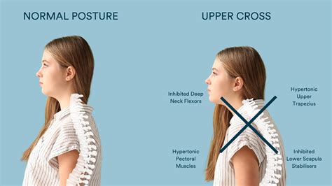 4 Exercises For Upper Cross Syndrome Rehab Superwell