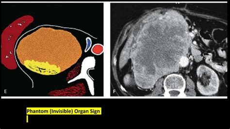 Retroperitoneal Mass And Retroperitoneal Anatomy Pptx
