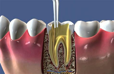 Кіста зуба ≡ Лікування кісти зуба в Ірпені Mysmile®