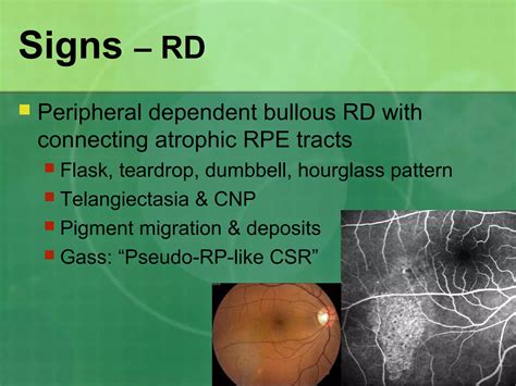 Central Serous Retinopathy Ppt