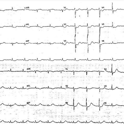 At The Er An Ecg Revealed Significant St Segment Depression In Leads