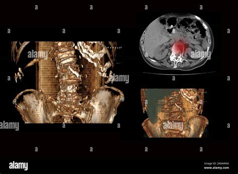 Computed Tomography Of The Spine With A Fracture Of The Vertebrae And