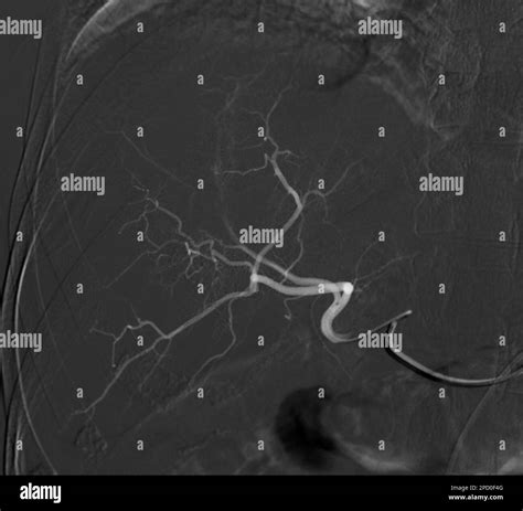 Imaging Of Tace Or Chemoembolization Is A Procedure That Allows A Dose Of Chemotherapy Drugs To Imaging Of Tace Or Chemoembolization Is A Procedure That Allows A Dose Of Chemotherapy Drugs To
