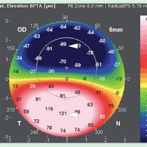 A Four Image Composite Map Of A Patient With Keratoconus Galilei The Download Scientific