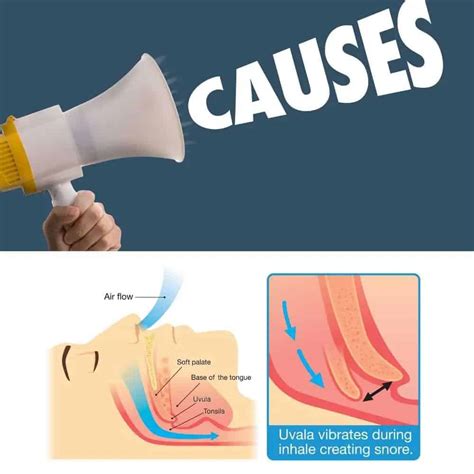 What Causes Snoring Snore Doc