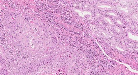 Squamous Cell Carcinoma Of The Gallbladder Ottawa Atlas Of Pathology