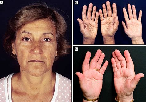 Addisons Disease Causes Symptoms Diagnosis And Treatment