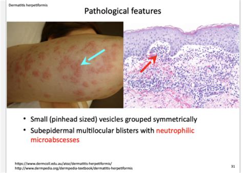 Pruritis Urticaria And Angioedema E2 Flashcards Quizlet
