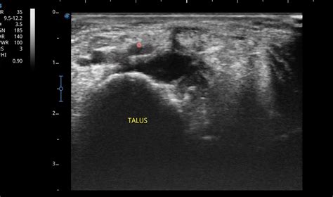 Echographie Dune Entorse De Chopart