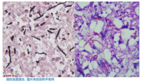 组织病理学何时可能是“侵袭性真菌病”唯一的重要诊断手段？检测霉菌感染时又有哪些优点和局限？腾讯新闻