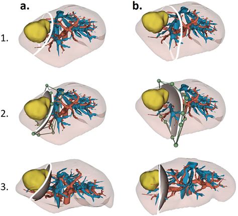 Virtual Resection Planning Steps 1 Positioning A Resection Line And A Download Scientific