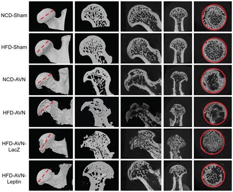 Radiographs And Histological Findings For Infarcted Femoral Heads