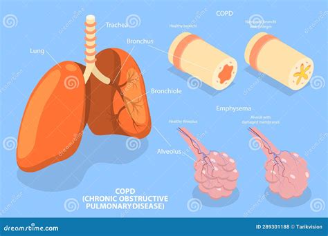 3d Isometric Flat Vector Conceptual Illustration Of Copd Stock Vector