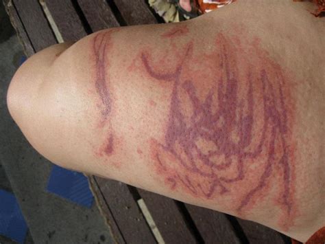 Managing Jellyfish Stings Emergency First Aid Course
