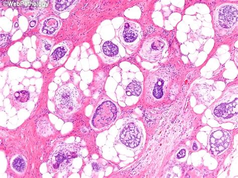Adenoid Cystic Carcinoma Stromal Differentiation