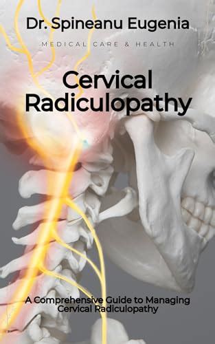 A Comprehensive Guide To Managing Cervical Radiculopathy By Dr