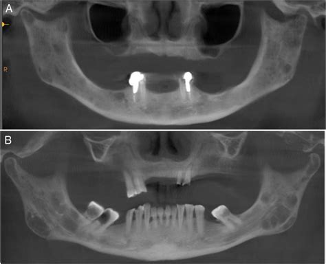 Panoramic Reconstruction On Cone Beam Computer Tomography Imaging Of