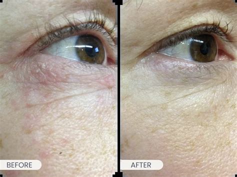 Dermatology Perioral Dermatitis Azova