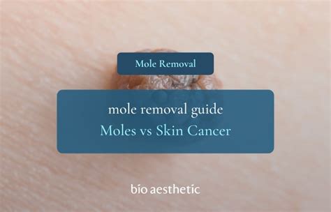 How To Spot Dangerous Moles Abcde Guide For Skin Cancer