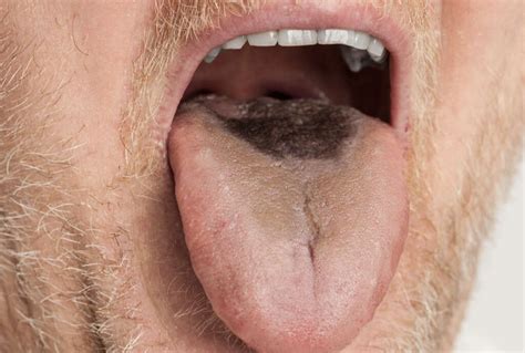 Pinworm Infection What Is Pinworm Infection