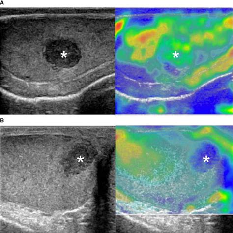 Incidentally Detected Complex Testicular Cyst A Gray Scale Download Scientific Diagram