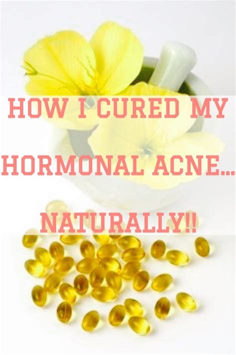 How I Cured My Hormonal Acne… Naturally Hormonal Acne Natural Acne