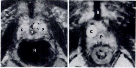 Lateral Prostatic Cyst Transverse Mr Image 200050 Cyst Arrows In