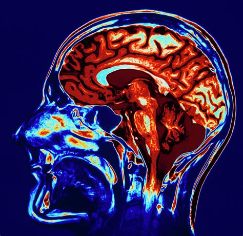 Coloured Mri Scan Of Brain In Sagittal Se Photograph By Geoff Tompkinson Fine Art America