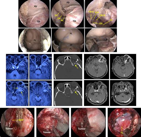 Case 2 A 44 Year Old Woman Presenting With A Left Sided Spheno Orbital